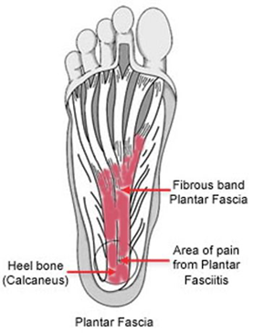 What is Plantar Fasciopathy?