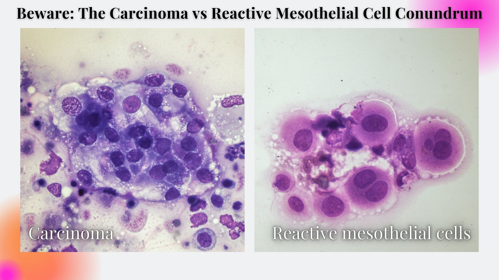 The Carcinoma Vs Reactive Mesothelial Cell Conundrum The Carcinoma Vs Reactive Mesothelial Cell Conundrum
