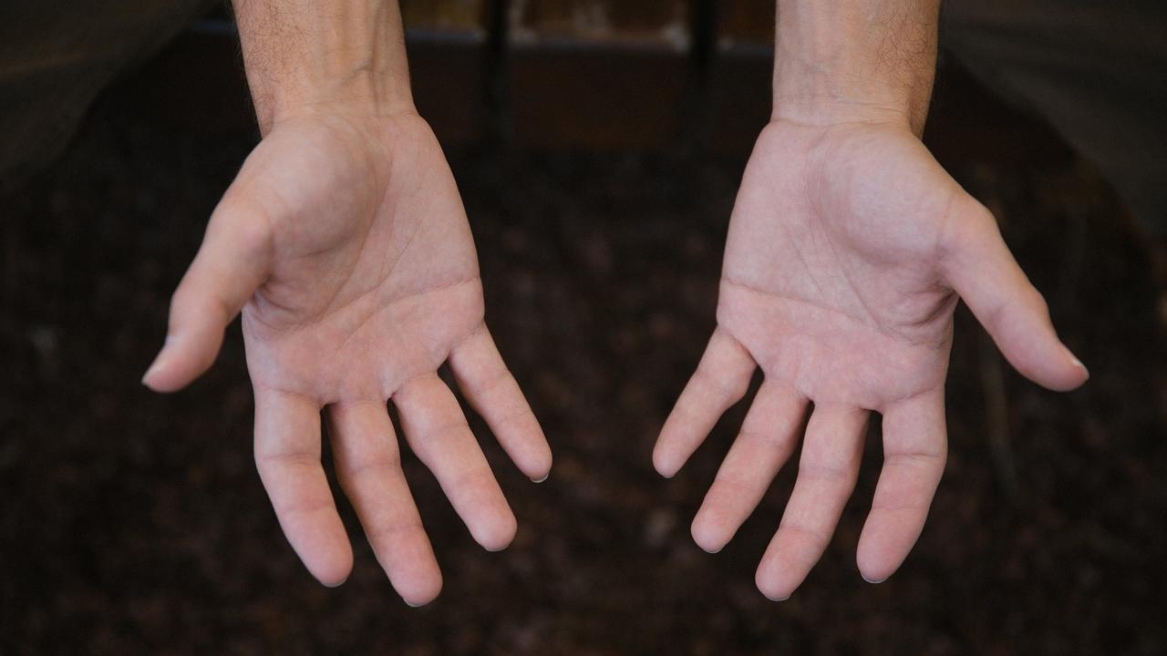 Hot hands during treatment