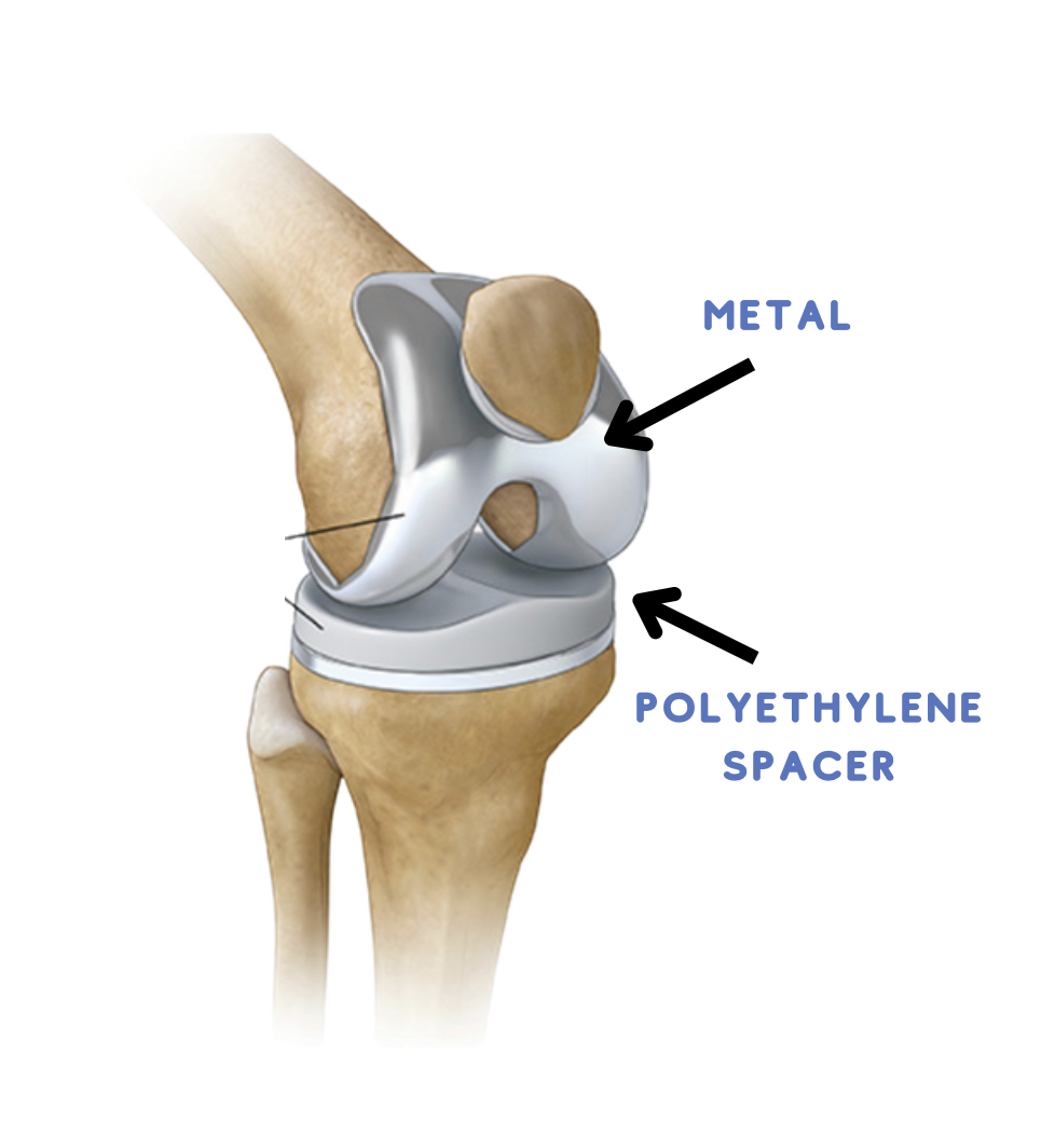 What Helps Nerve Pain After Knee Replacement