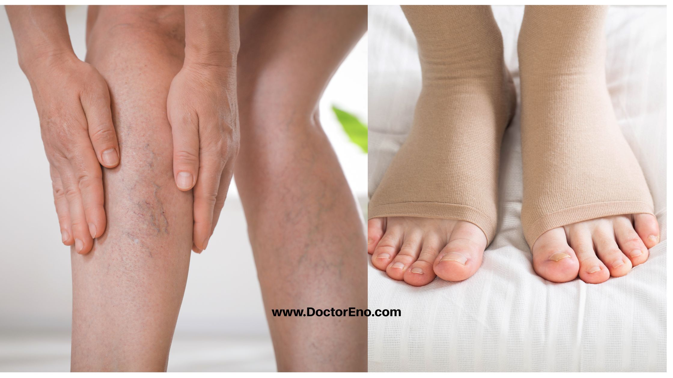 🦵🏽 Doctor Eno Says- Understanding Chronic Venous Insufficiency (CVI)