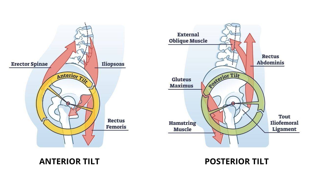How Pelvic Tilt Affects Your Back Pain (and How to Fix It)