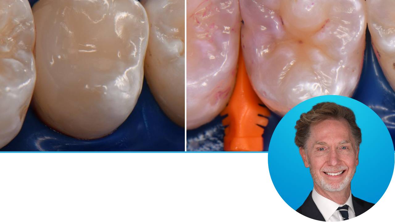 Perfect Your Next Class II Restoration with Posterior Matrix System