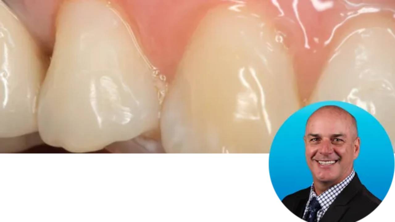 Optimizing Dental Treatments: Advanced Techniques Bulk Fill Composites