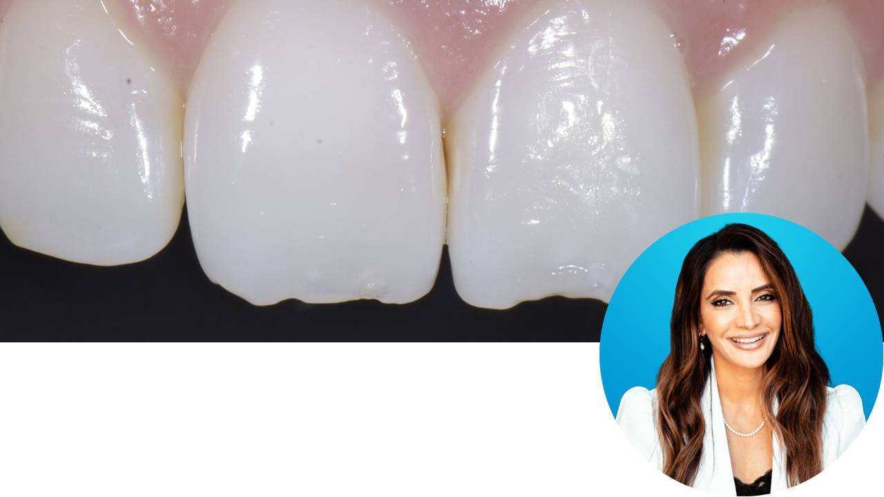 The Art of Incisal Enhancement With Dr. Dimple Desai