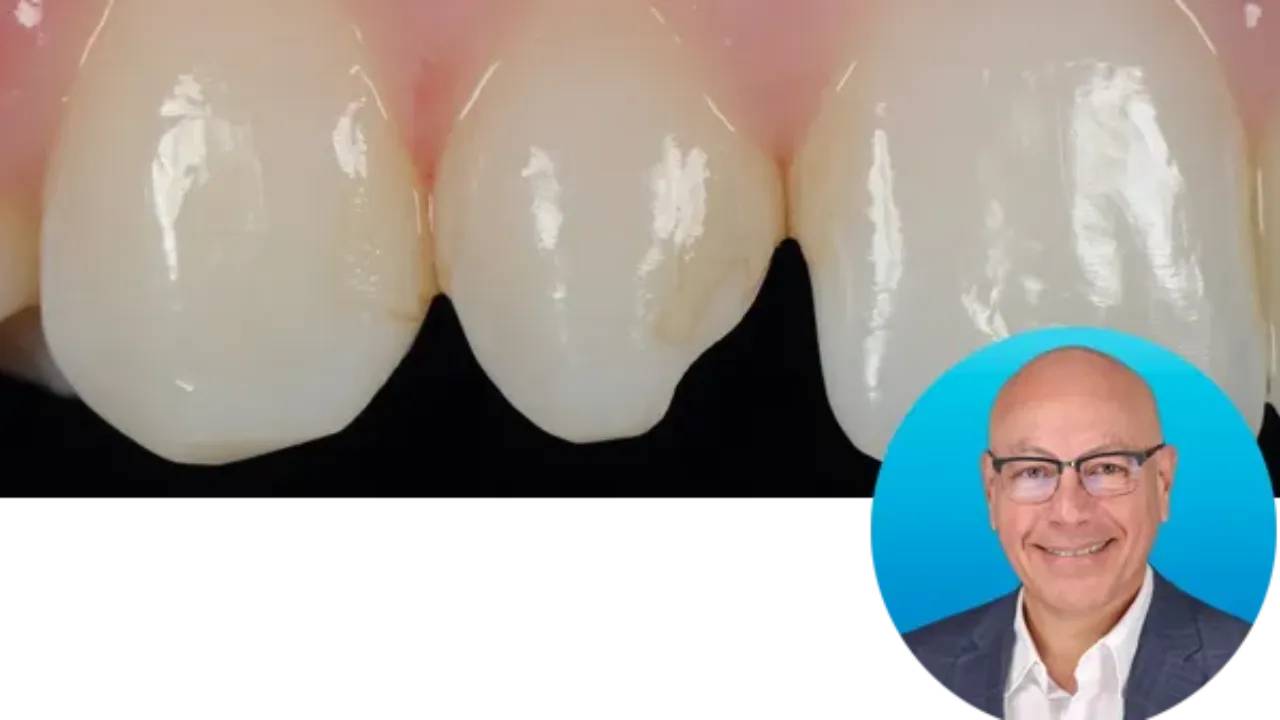 Mastering Injectable Flowable Composites: Techniques for Restorations