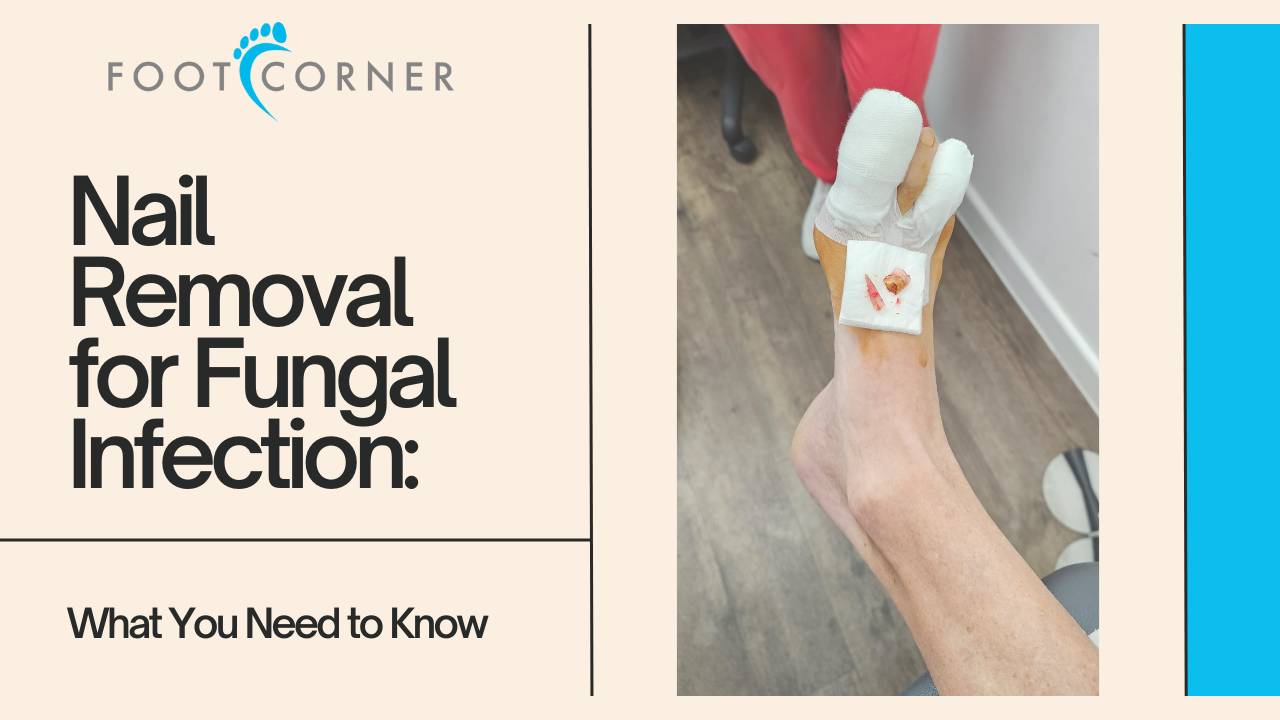 Nail Removal for Fungal Infection: What You Need to Know