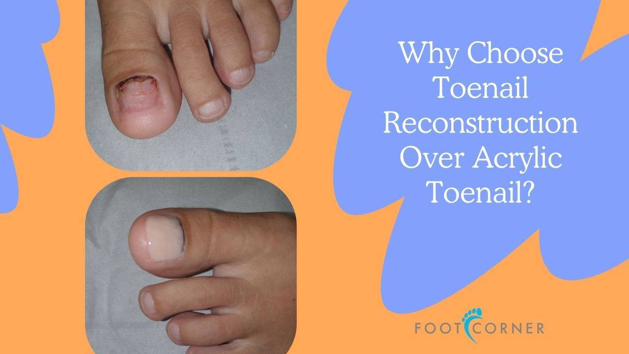 Why Choose Wilde Toenail Reconstruction Over Acrylic Nails?