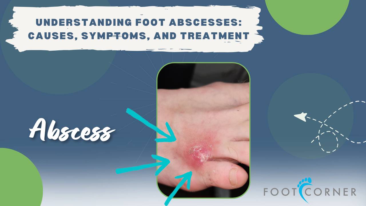 Understanding Foot Abscesses? Causes, Symptoms, and Treatment