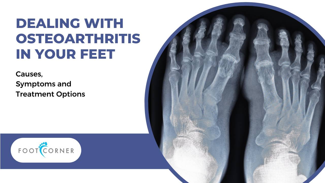 How To Treat Osteoarthritis Of The Foot at Mary Settle blog