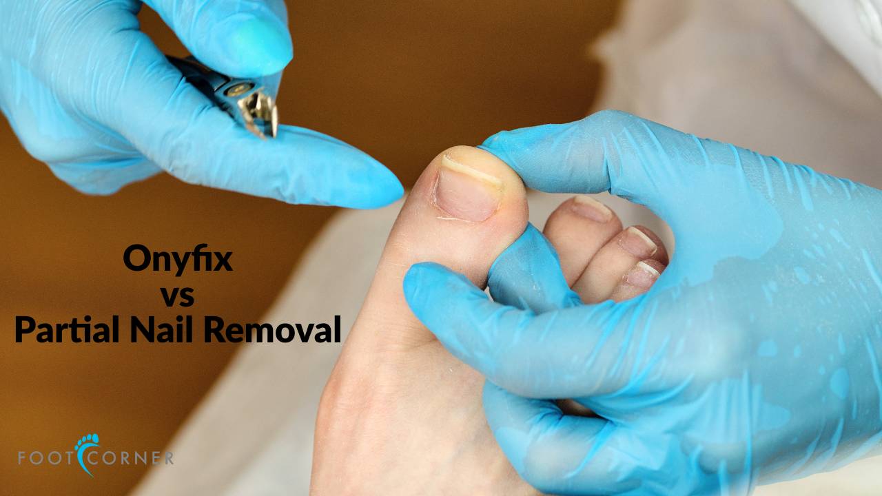 Onyfix vs Partial Nail Removal