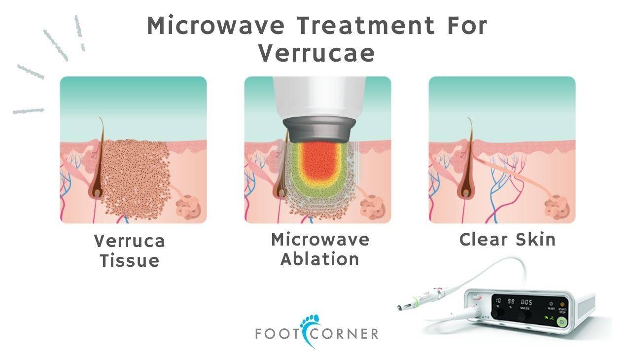 Microwave Treatment For Verrucae