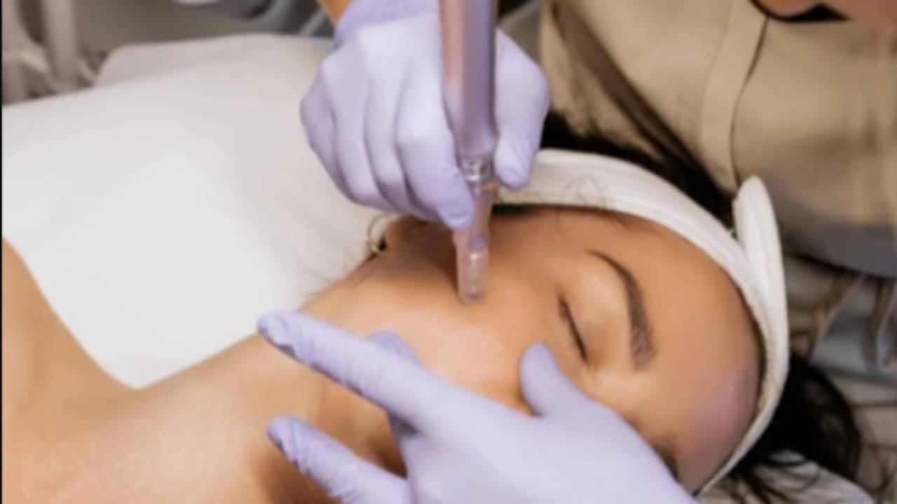Microneedling for Acne Scars and Wrinkles