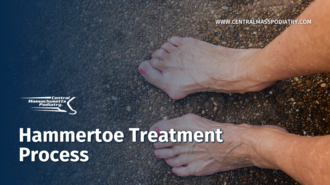 Hammertoe Treatment Process