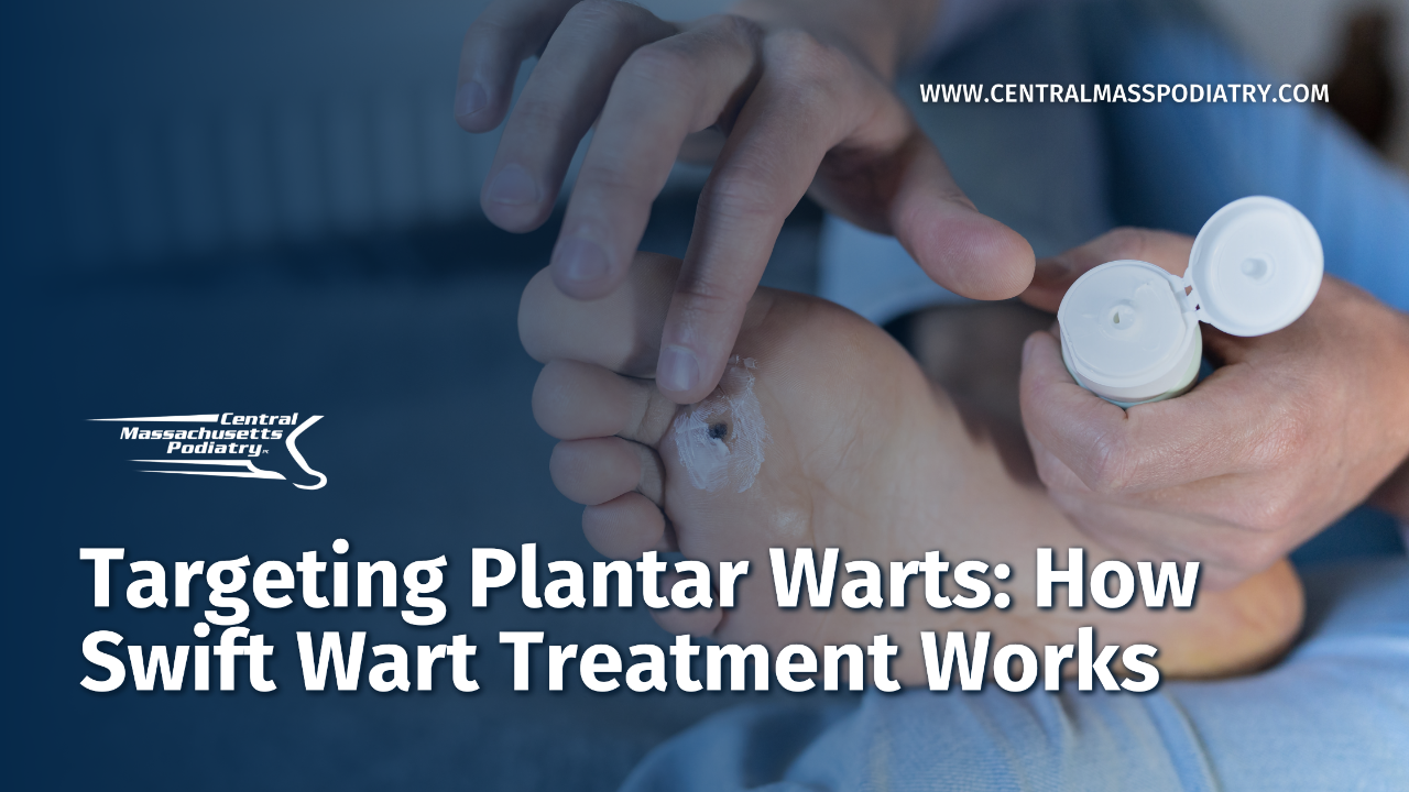 Plantar Wart Root Removal