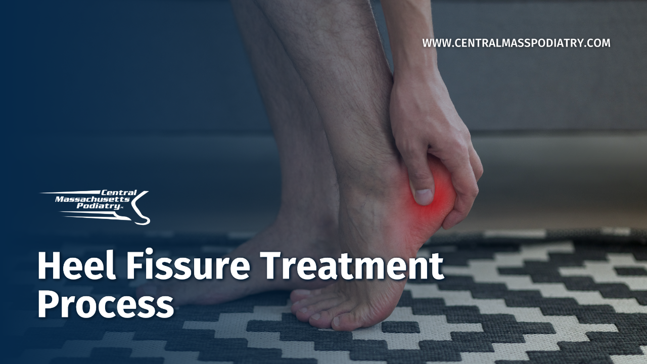 Heel Fissure Treatment Process