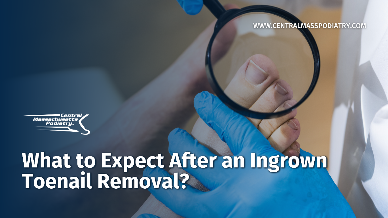 Recovery from Ingrown Toenail Removal | Central MA Podiatry