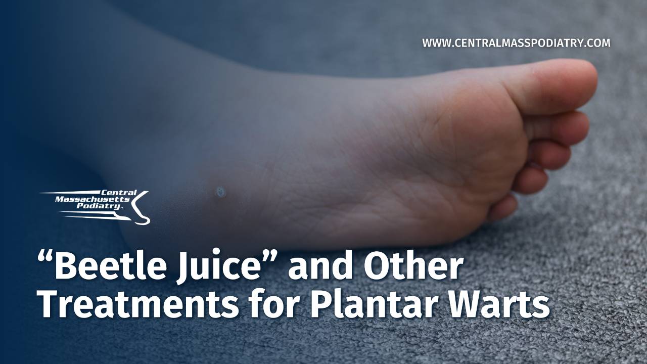“Beetle Juice” and Other Treatments for Plantar Warts