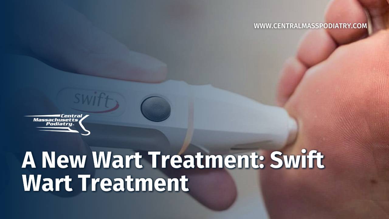 A New Wart Treatment: Swift Wart Treatment