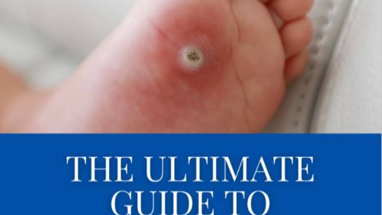 The Ultimate Guide To Wart Treatments