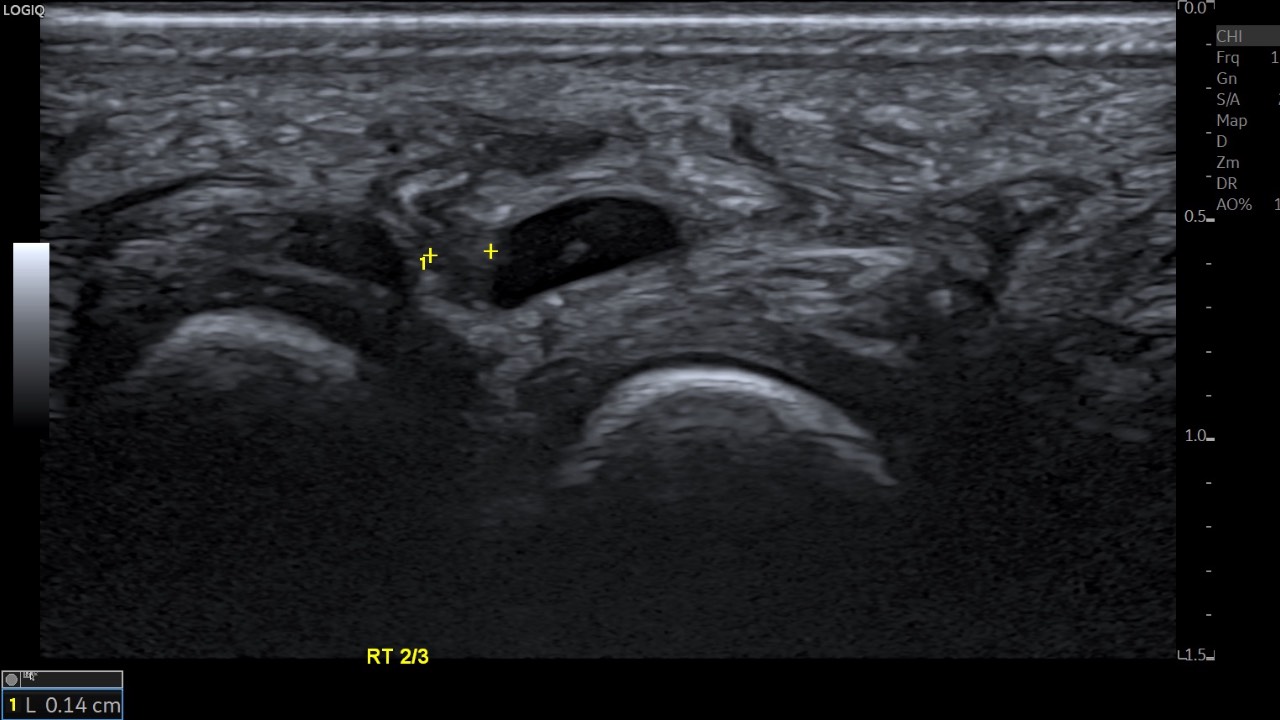 Paraplate cyst of the plantar plate