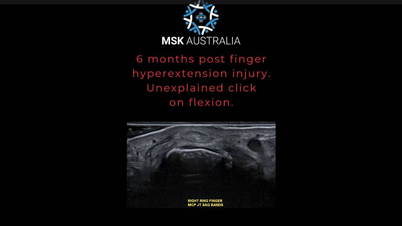 Unusual cause for finger click