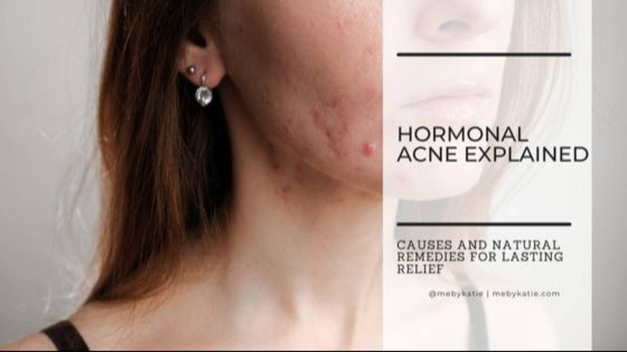 Hormonal Acne Explained: Causes and Natural Remedies