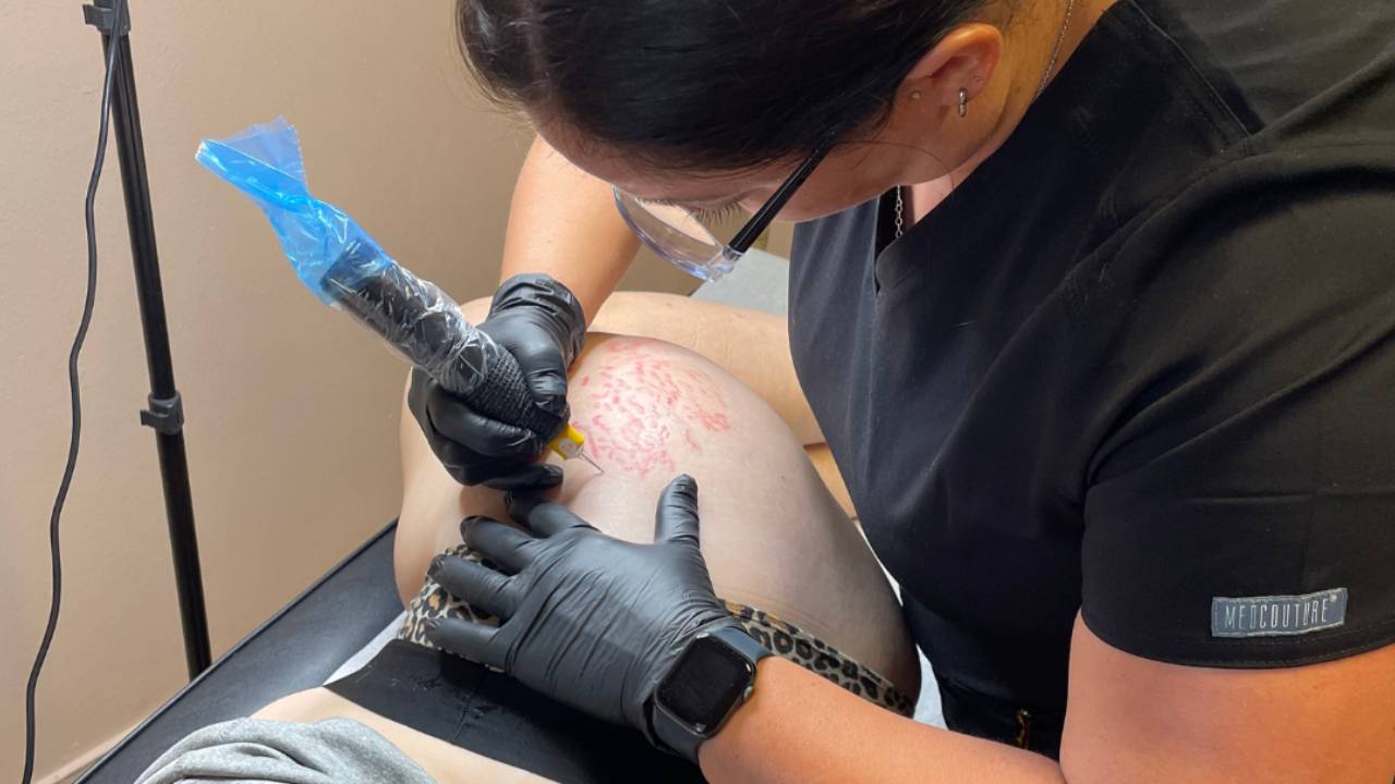 The Do's and Don'ts After an Inkless Stretch Marks Repair Service