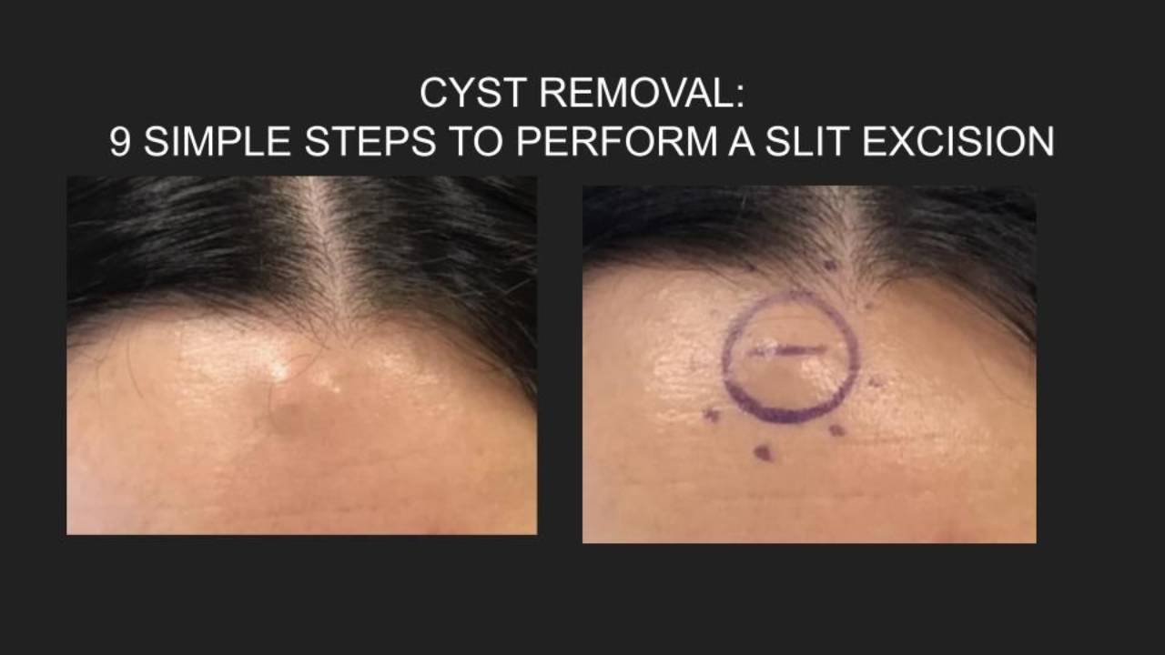 Video: Steps for Cyst Removal