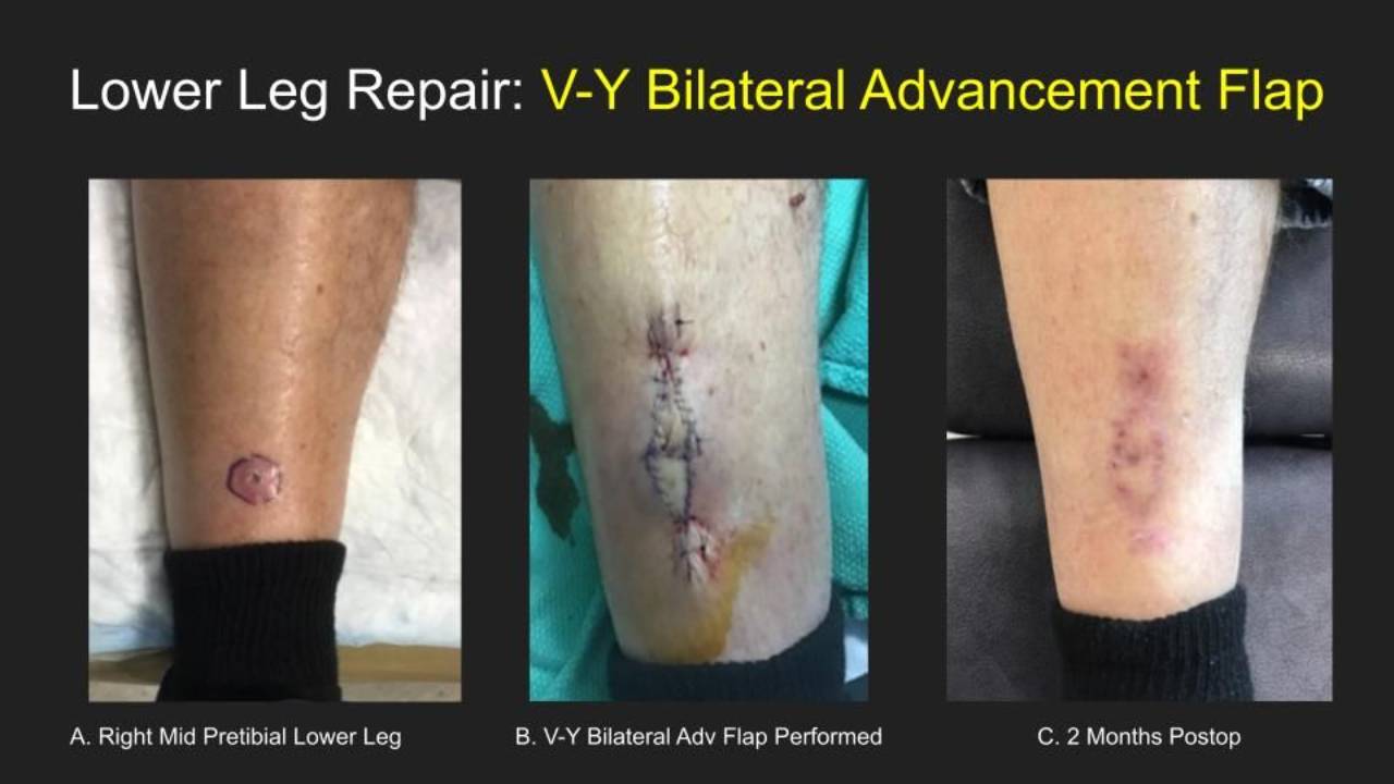 The V-Y Bilateral Advancement Flap