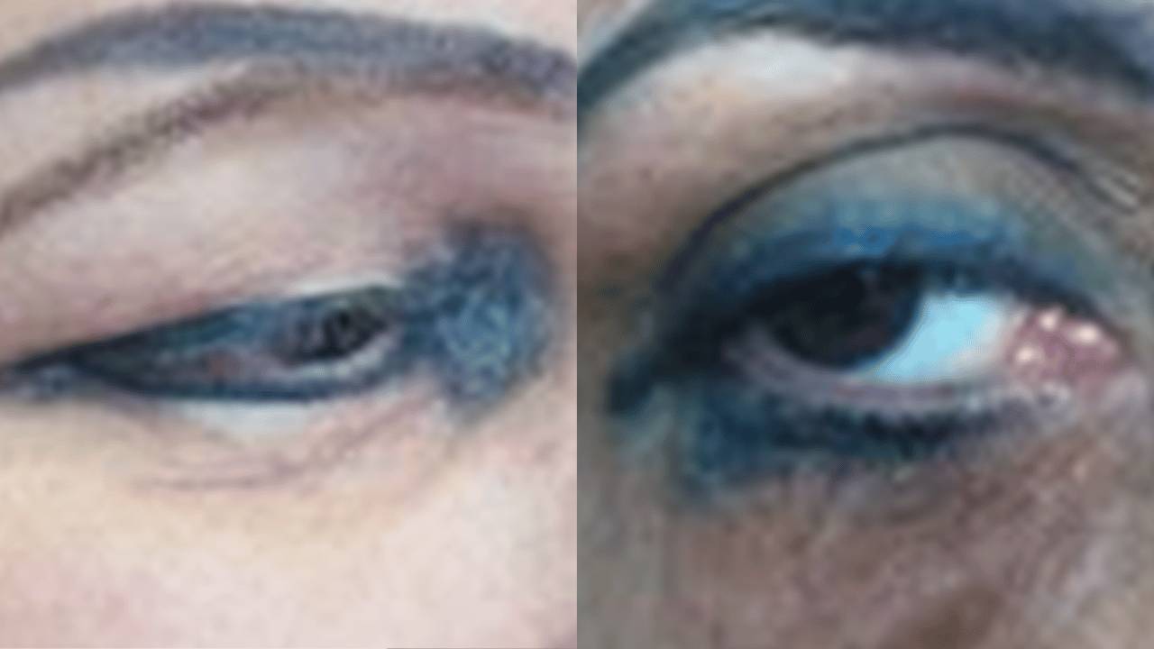 The Ins and Outs of Eyeliner Migration and Removing Tattooed Eyeliner
