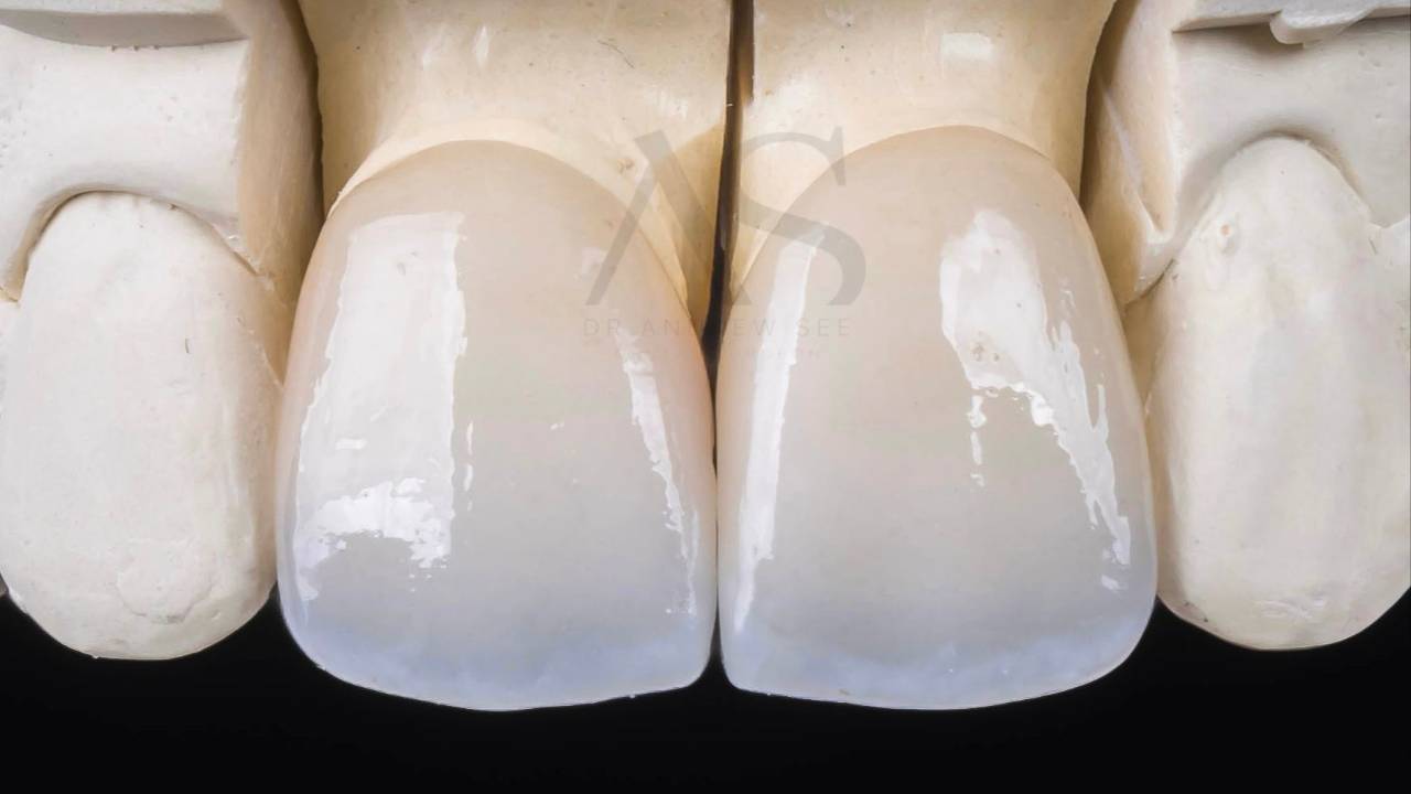 Central Incisor Veneers Case Study by Aesthetic Dentist Dr Andrew See