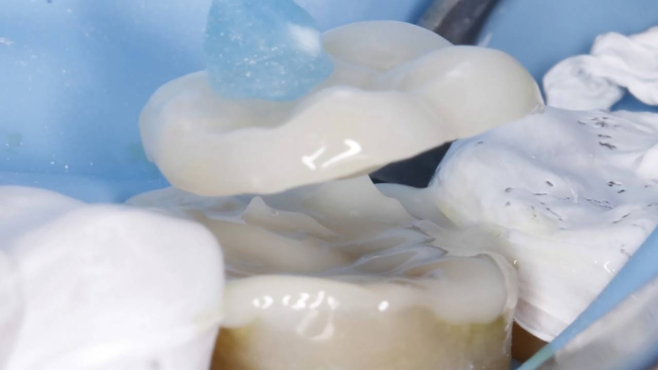 Glass-Ceramic Tabletop Restoration by Aesthetic Dentist Dr Andrew See