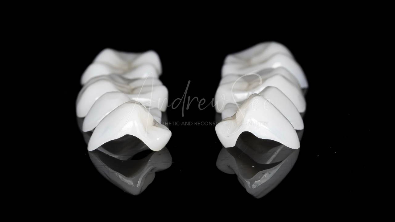 Indirect Posterior Dentistry: Strategies for Optimal Planning