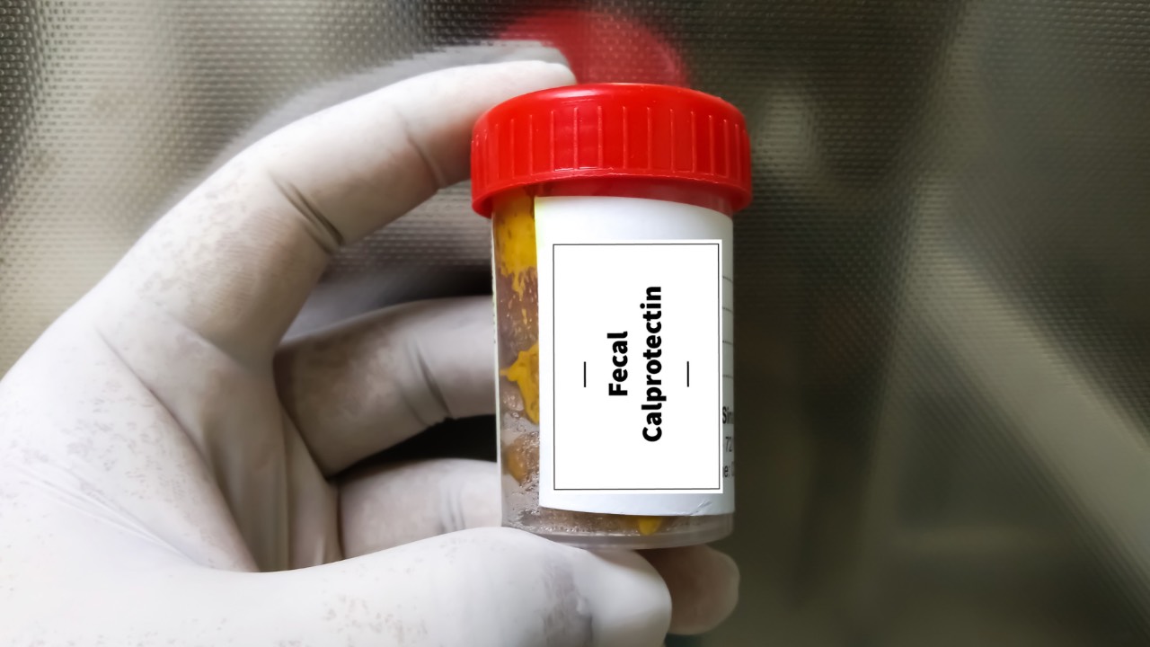 Qué es la calprotectina para medir la inflamación gastrointestinal