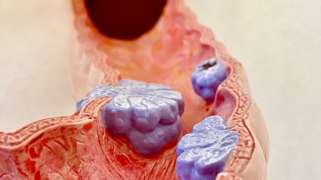 ¿Qué son los pólipos en el colon?
