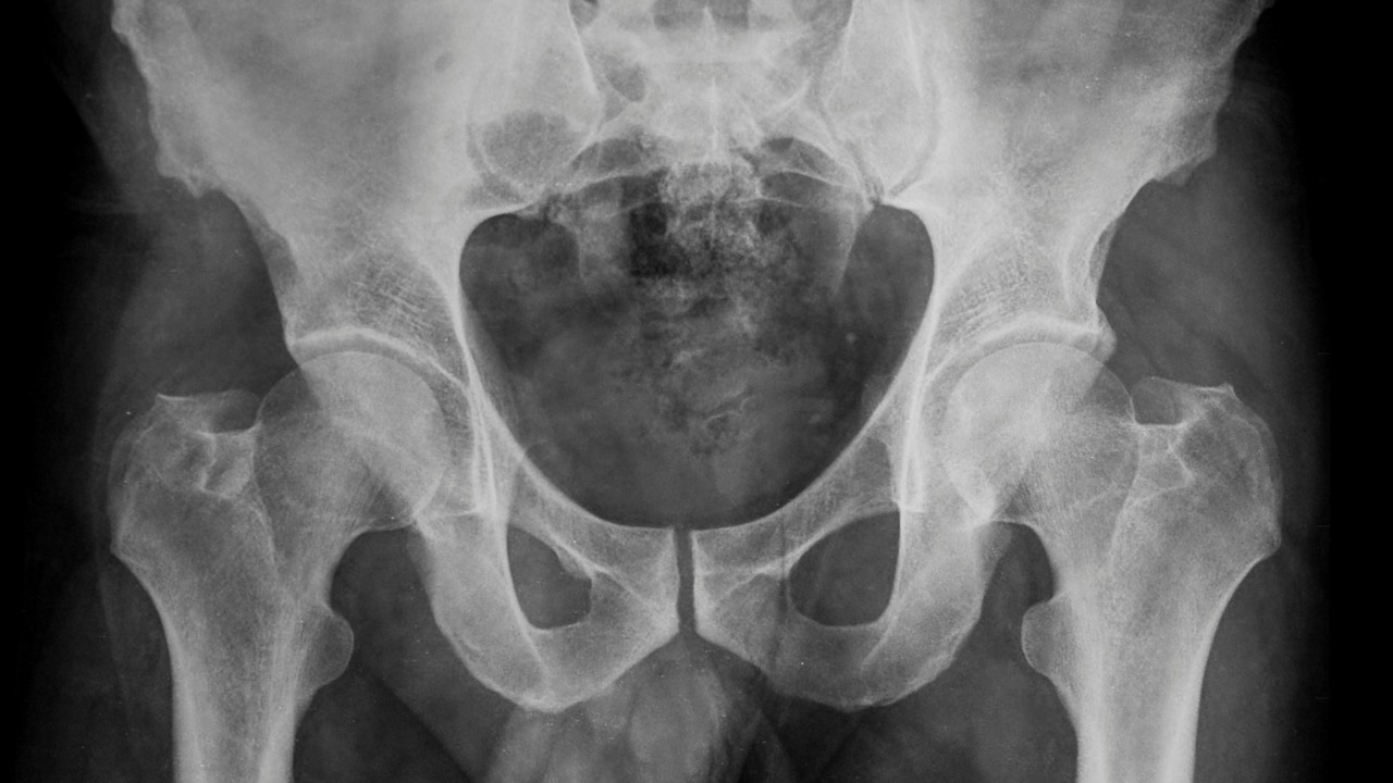 Why Fuelling Is So Important For Cyclists Bone Health