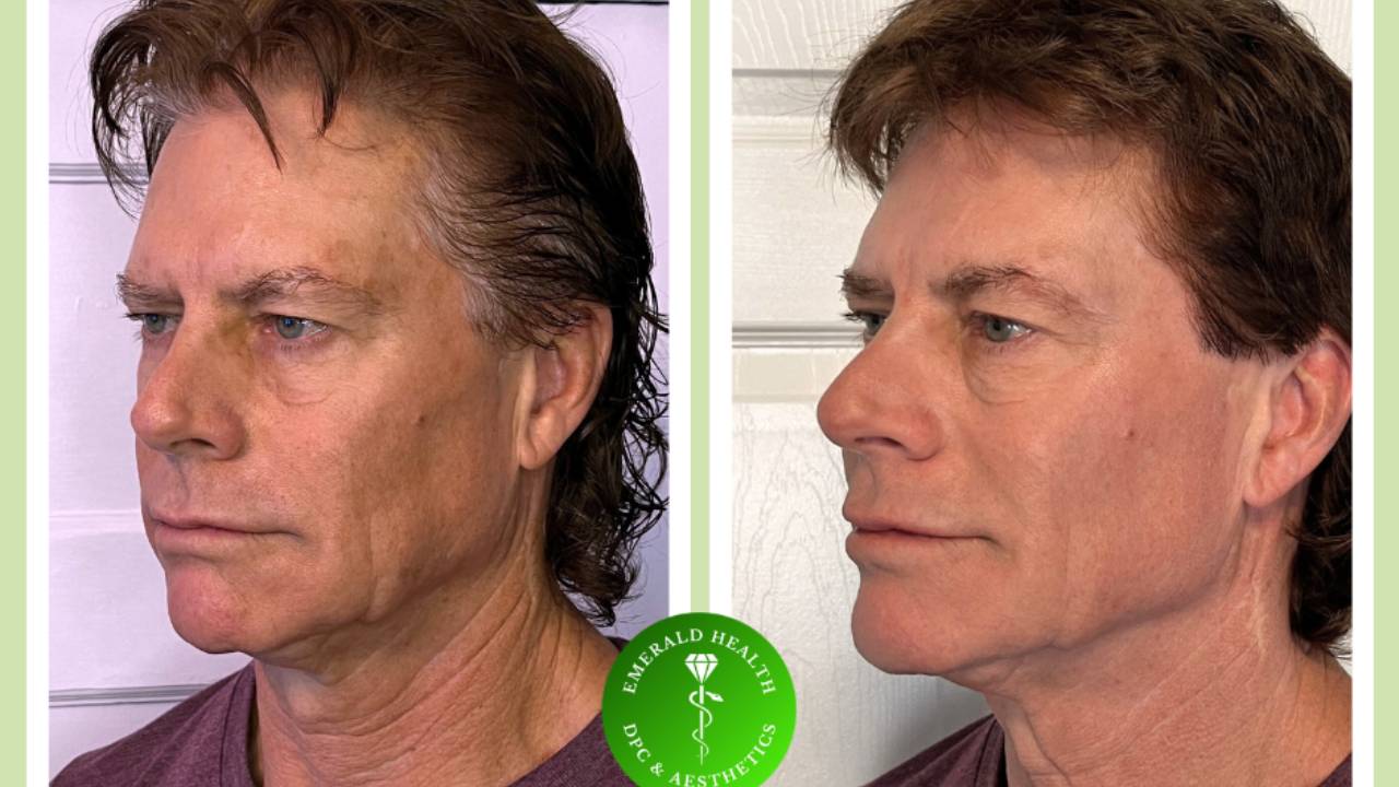 NeoGen PSR Skin Rejuvenation | Emerald Health | Hickory NC
