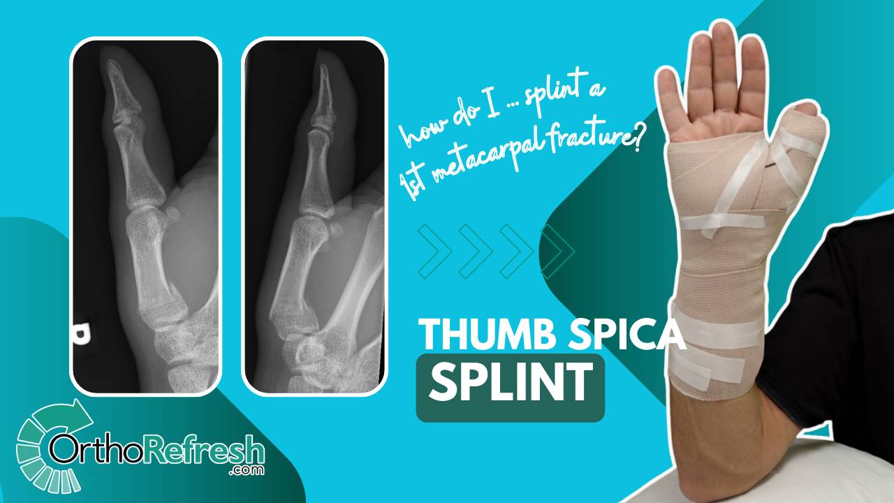 How do I ... splint a 1st metacarpal fracture?