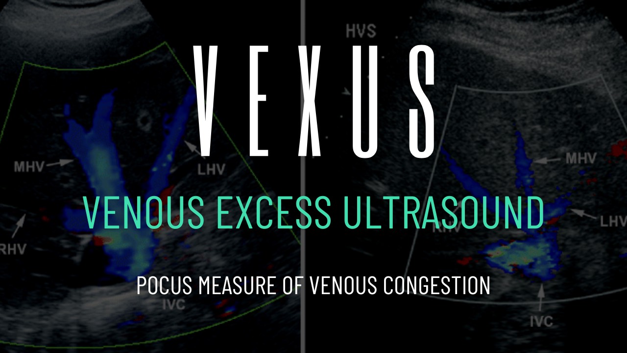 VExUS