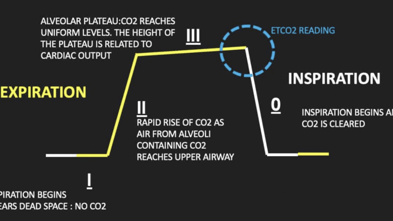 Capnography to guide ventilation in cardiac arrest.