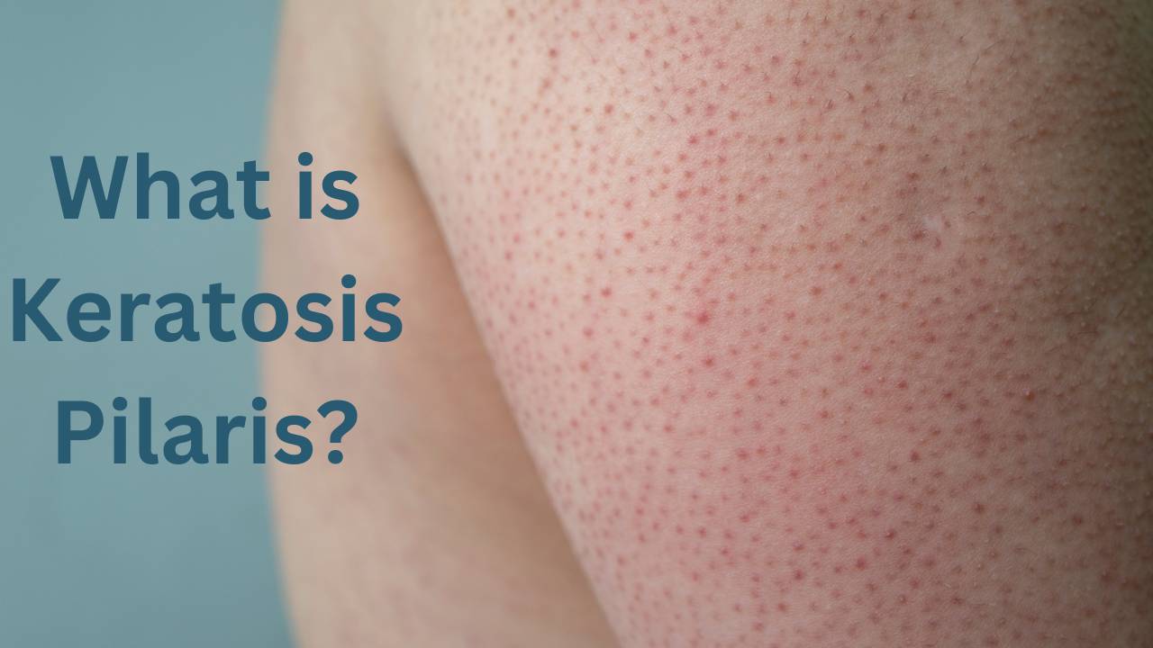 What is Keratosis Pilaris?