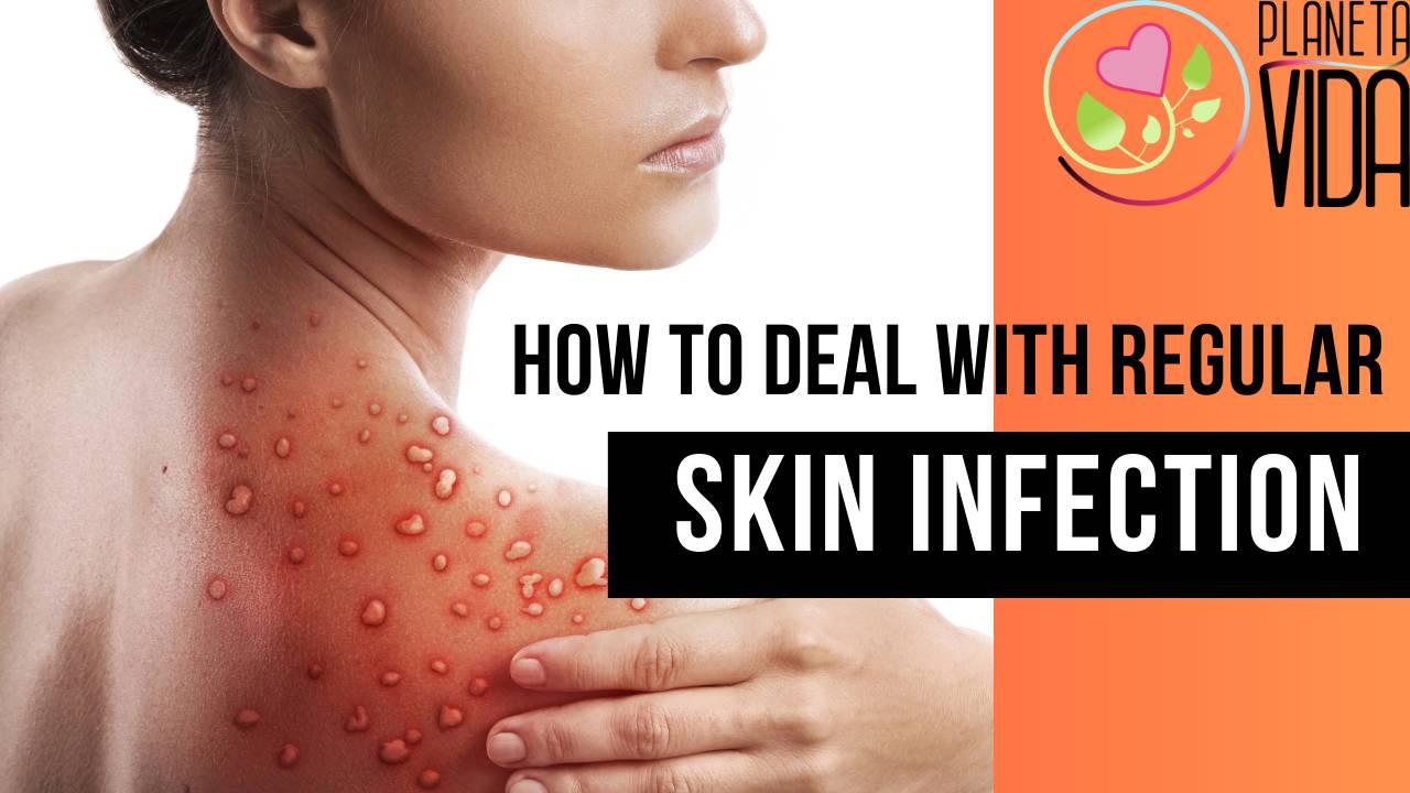 How to deal with regular skin infections?