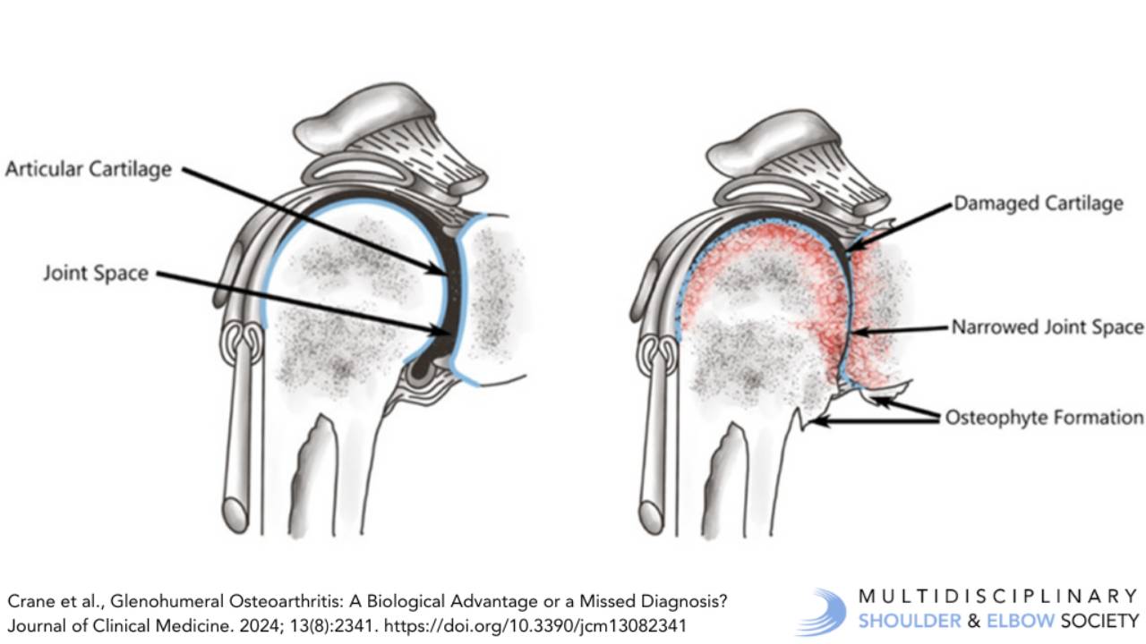Glenohumeral Joint Osteoarthritis Classifications