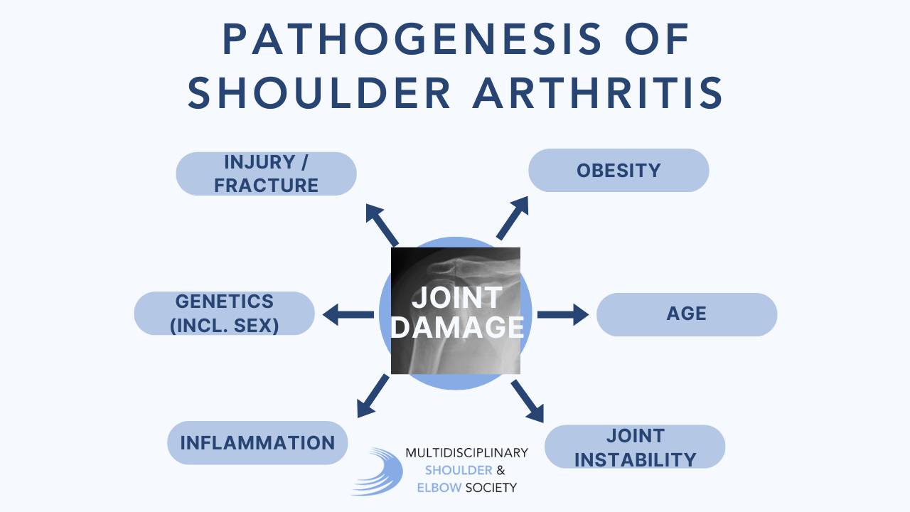 Pathogenesis of Shoulder (Glenohumeral Joint) Osteoarthritis