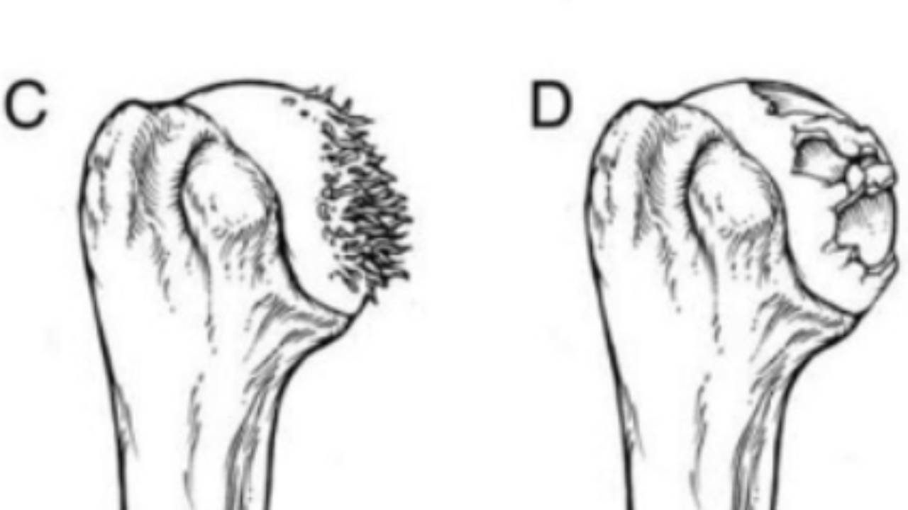 4 Phases of Humeral Head Arthritis