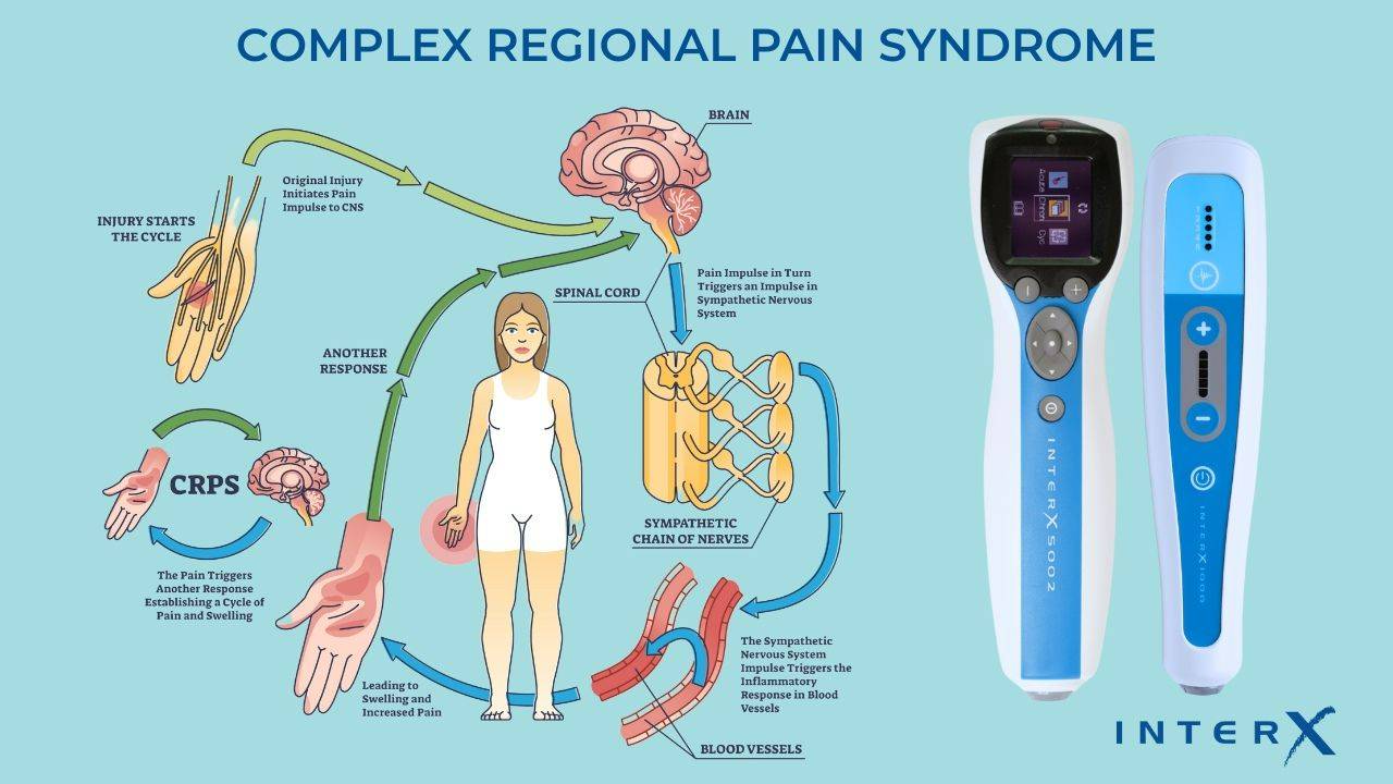 NIN Devices for Complex Regional Pain Syndrome (CRPS) and RSD Relief