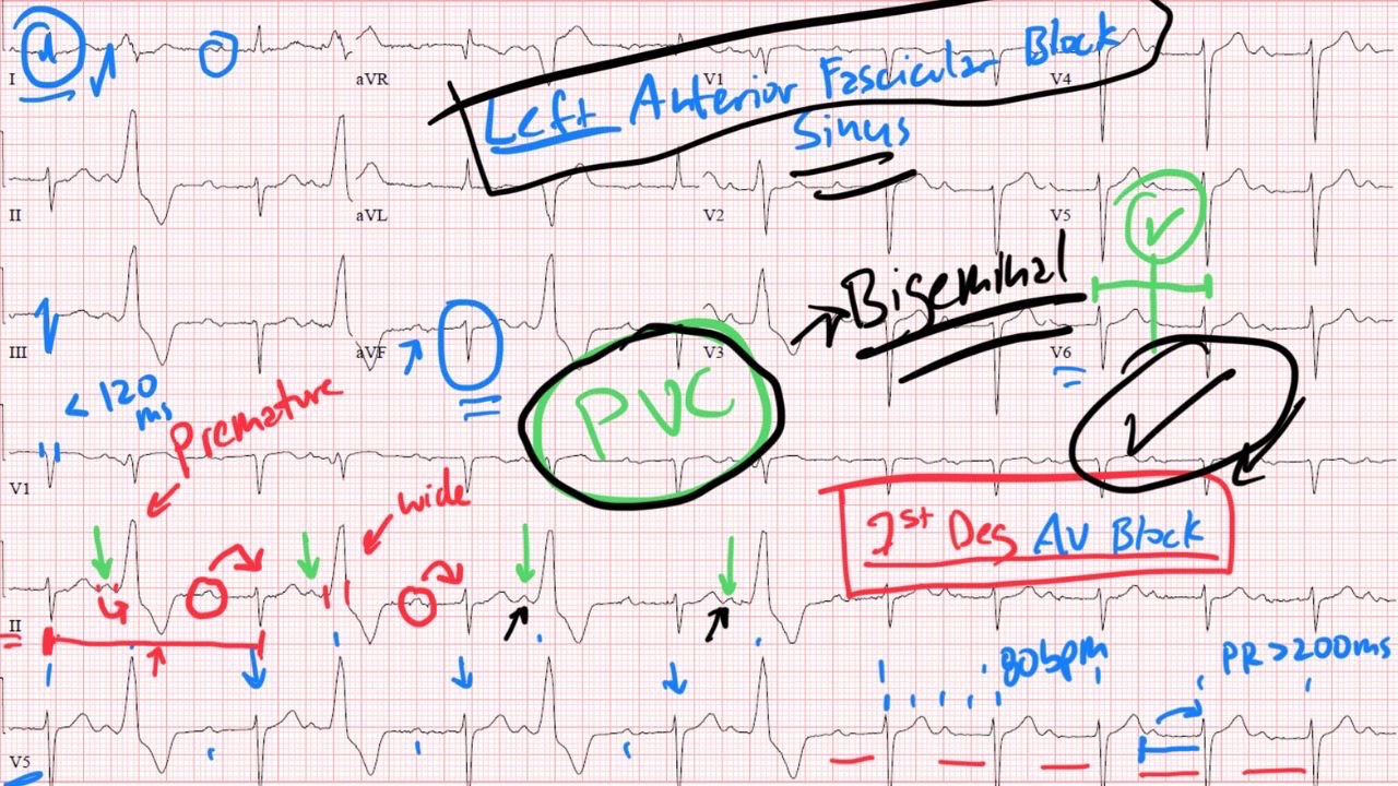 How to Approach Every ECG - Without Memorization