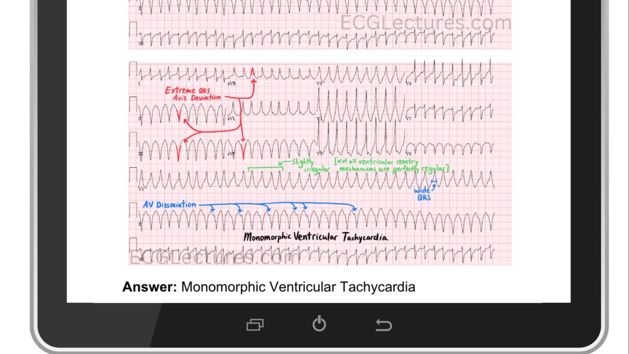 100 High Yield Annotated ECG's