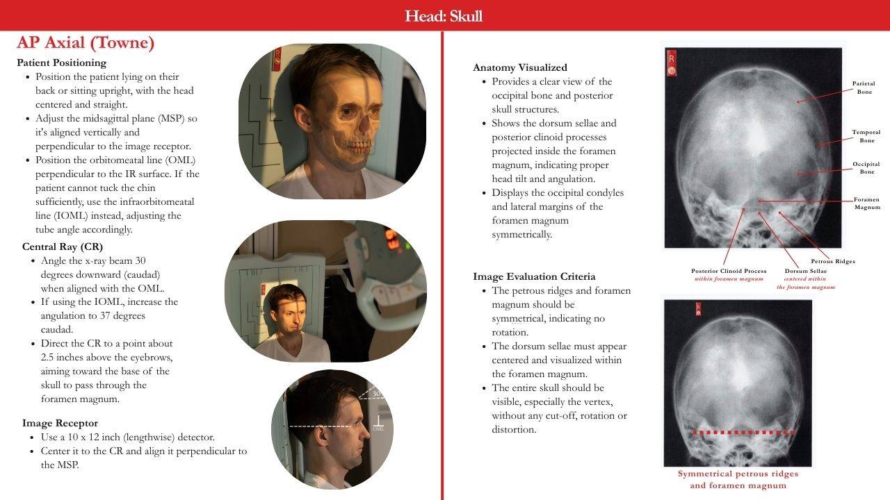 The Rontgen Atlas | Head | Skull | AP Axial (Towne)